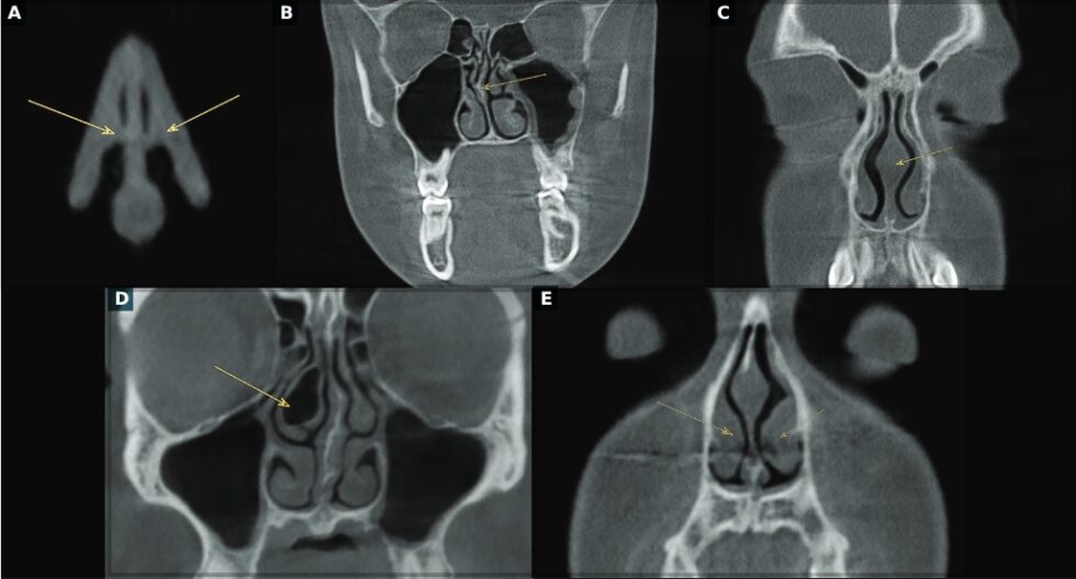 Nasal Airway Obstruction and Orofacial Pain